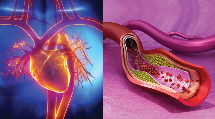 Arterial Plaque Rupture | Life Extension Magazine